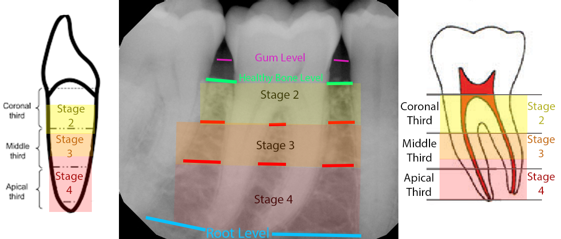 Dental Disease Detection