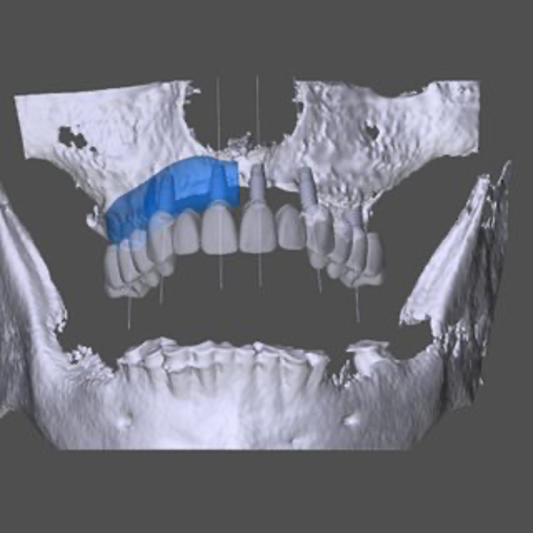Dental Disease Detection
