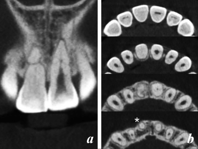 Dental Disease Detection