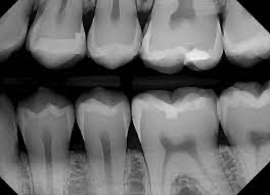 Dental Disease Detection